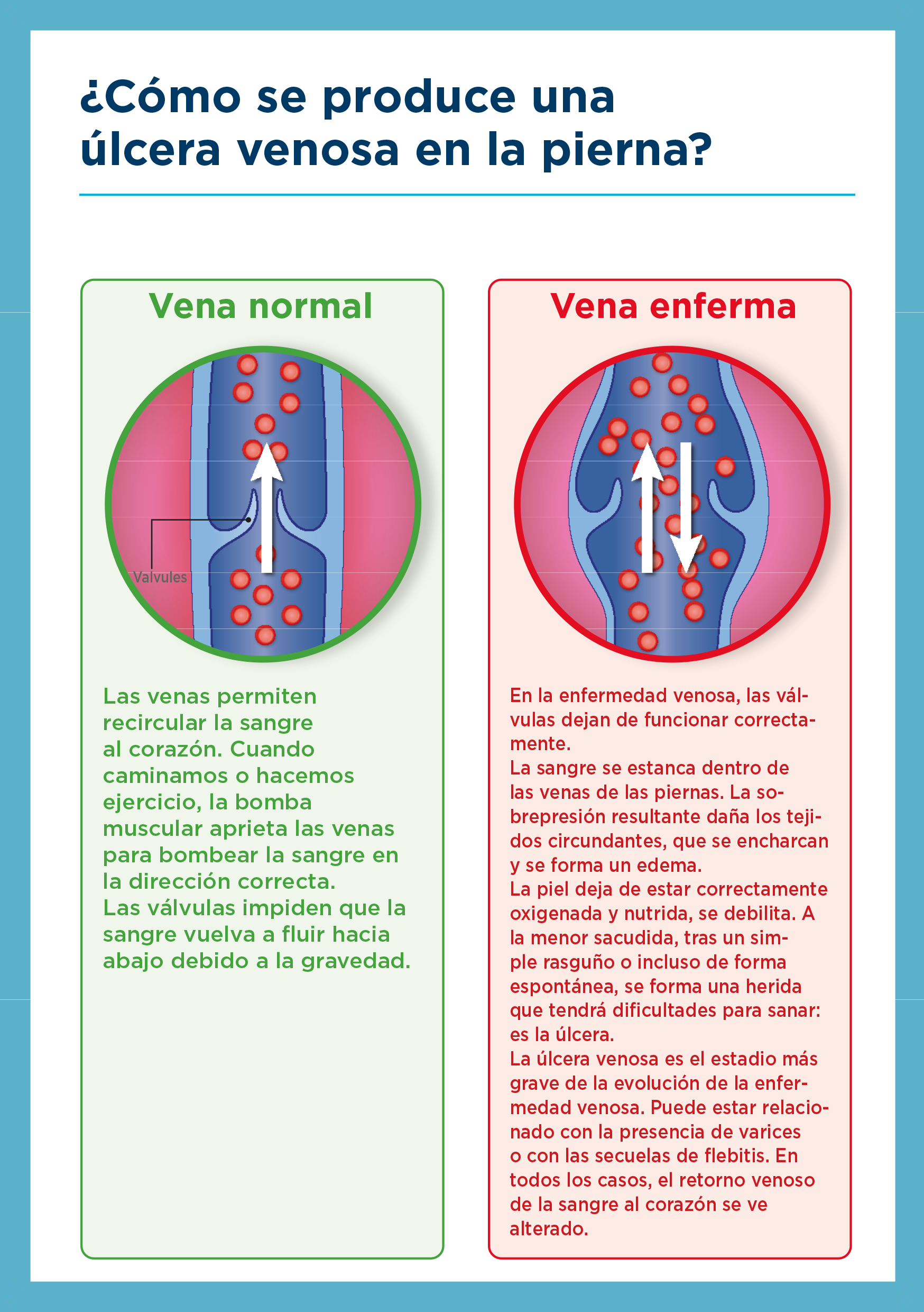 Úlcera de pierna - Urgo Medical te explica más sobre este tema