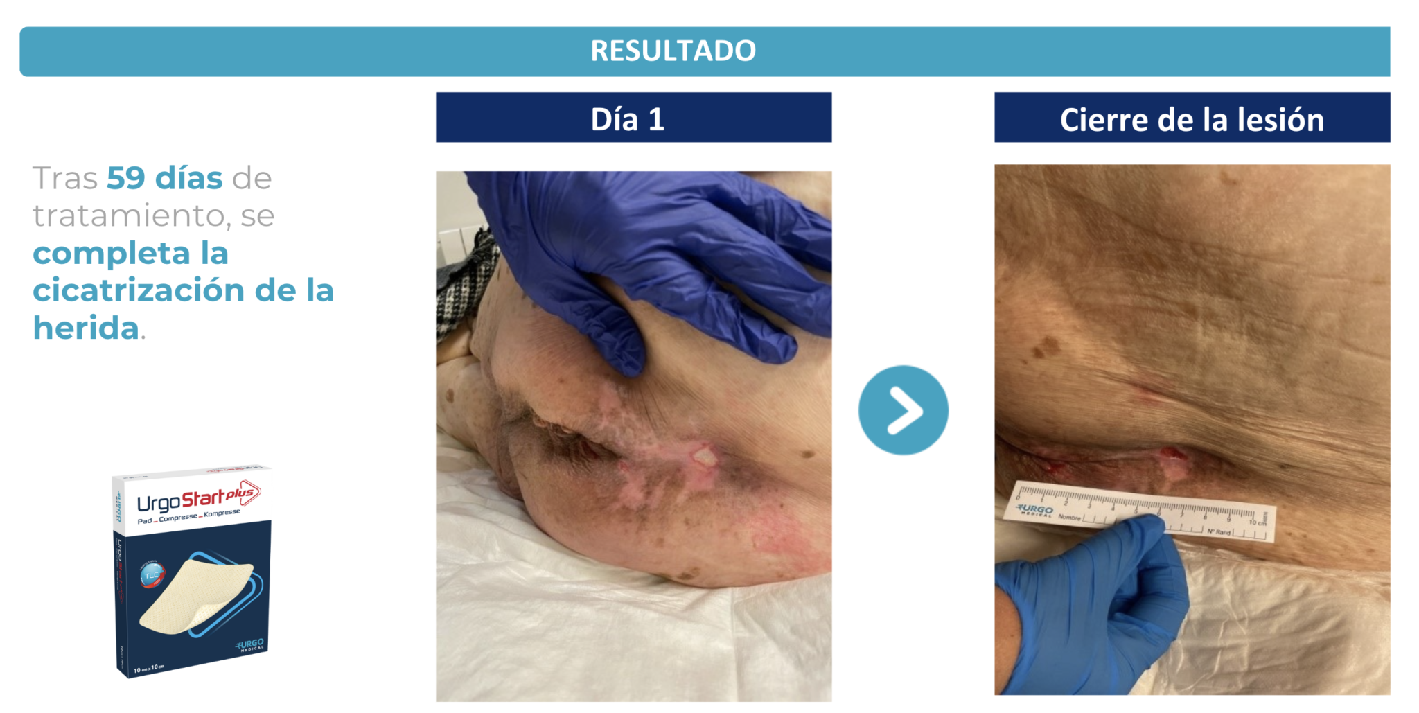 Úlcera por presión: Sacro con UPP Satélite | Urgo Medical