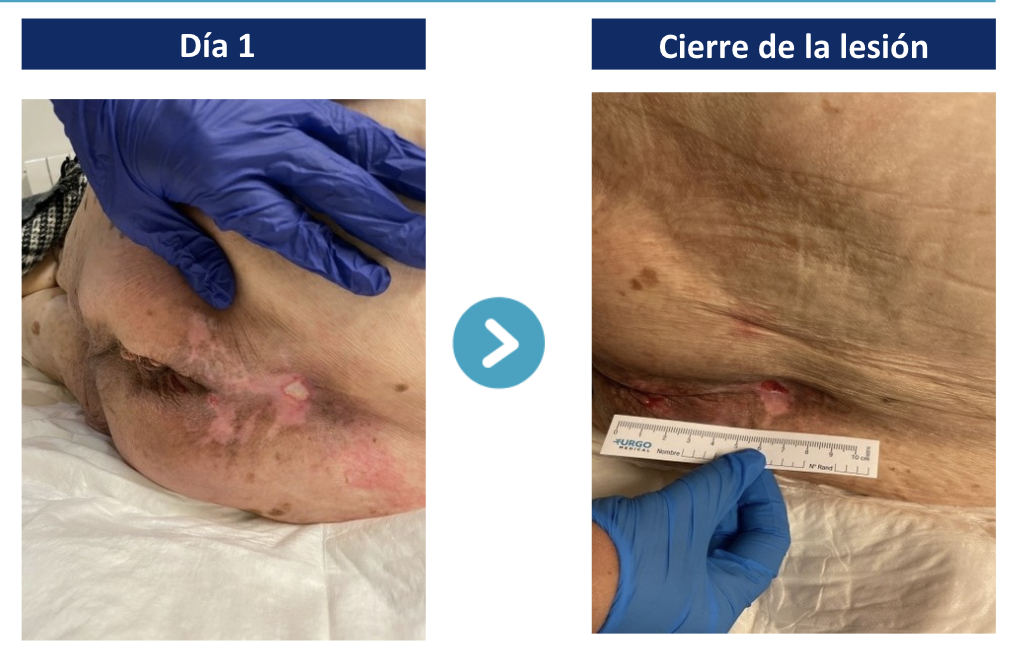 Úlcera por presión: Sacro con UPP Satélite | Urgo Medical