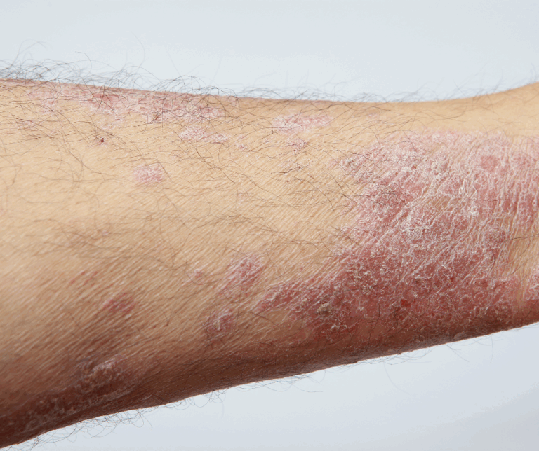Dermatitis por estasis: causas, síntomas y opciones de tratamiento ...